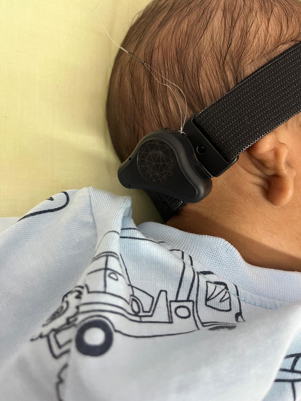 Adhear BAHA for Babies with Microtia | HearFon Success Story